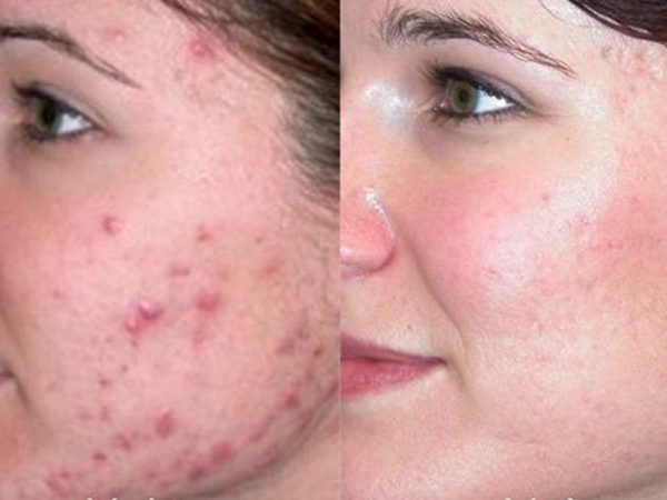 How To Get Rid Of Cheek Acne Amjad Medical how-to-get-rid-of-cheek-acne-amjad-medical
